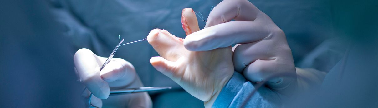 Kinderkrankenhaus Wilhemstift: Überzählige Finger und Zehen (Polydaktylie)