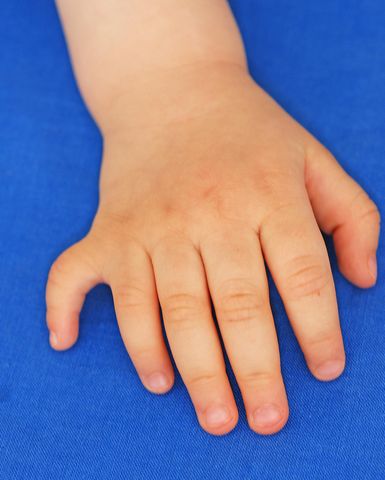 Kinderkrankenhaus Wilhemstift: Überzählige Finger und Zehen (Polydaktylie)